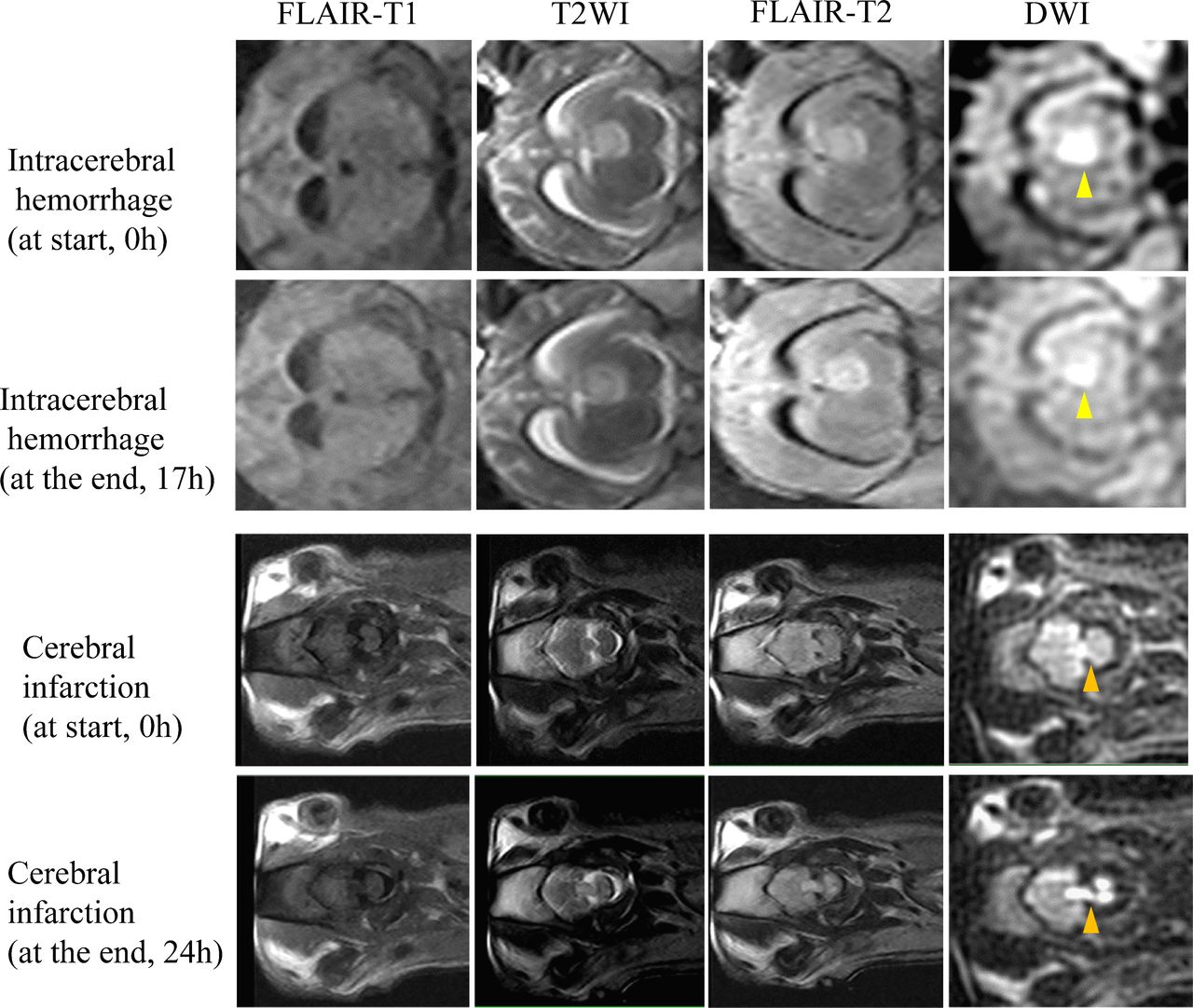 0.23-Tesla MRI to differentiate between ischaemic and haemorrhagic ...