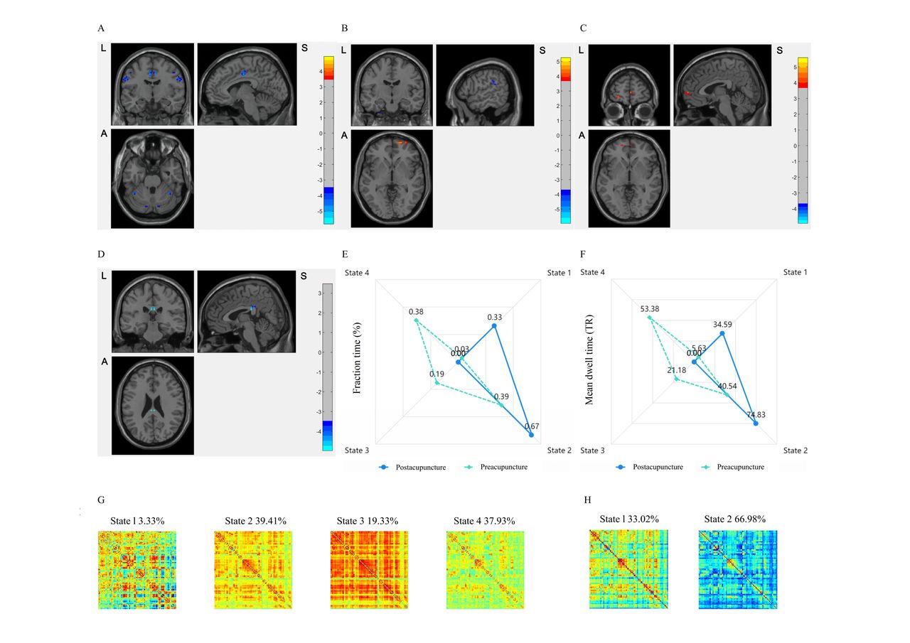 Quadrantanopia Stroke