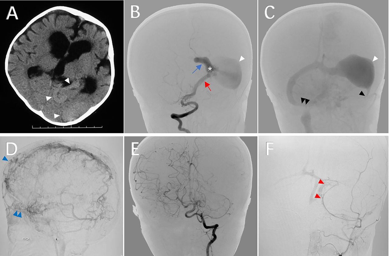 Angioarchitecture and prognosis of pediatric intracranial pial ...