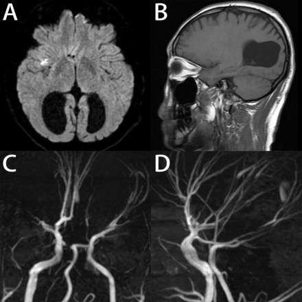 Cerebrovascular cinematic rendering of multisystemic smooth muscle ...