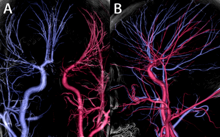 Cerebrovascular cinematic rendering of multisystemic smooth muscle ...