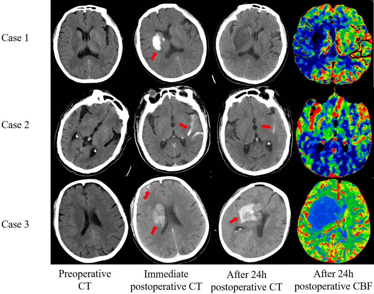 Prognostic significance of contrast staining following mechanical ...