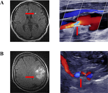 Incidence and impact of brain lesions and cognitive impairment after ...